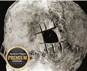 Prehistoric Surgery: Skull Operations Technically Superior To Our Own ...